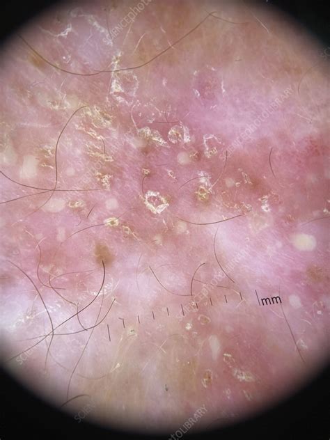 Ringworm Dermoscopy Stock Image C059 6974 Science Photo Library