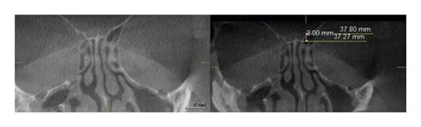 Coronal Plan Of Cbct Demonstrating Type 1 Keros Classification On The Download Scientific