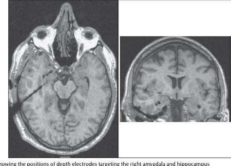 Pdf Superselective Anterior Temporal Resection In Mesial Temporal