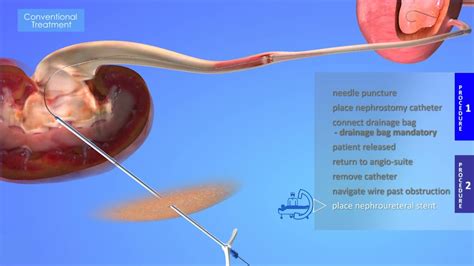 Ureteral Stents Nephrostomy Tubes And Urethral Dilators Ureteral Stent