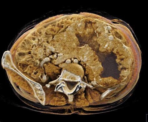 Large Gist Tumor With Neovascularity Gastrointestinal Radiology Case