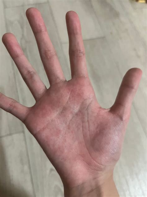 손에 붉은게 올라오고 따가워요 지식in