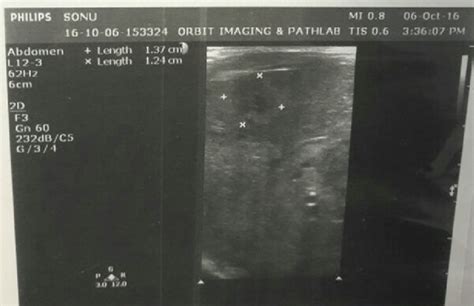 Echocardiography Revealed Severe Pulmonary Hypertension Copyright
