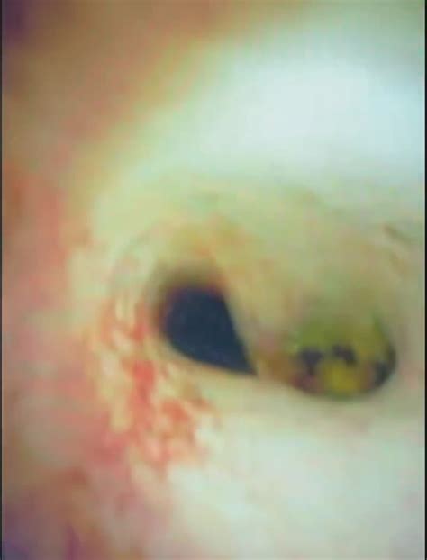 [video] Spyglass And Ehl For Biliary Surgery Thayer Nasereddin Posted On The Topic Linkedin