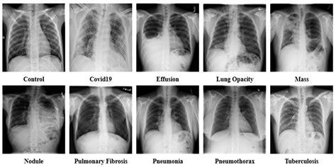 Pulmonary Fibrosis Chest X Ray My Xxx Hot Girl