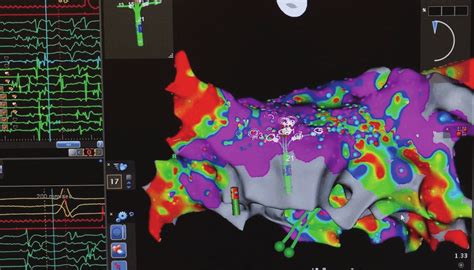Fractionated Electrograms Pentaray Catheter Over The Anterior Left Download Scientific Diagram
