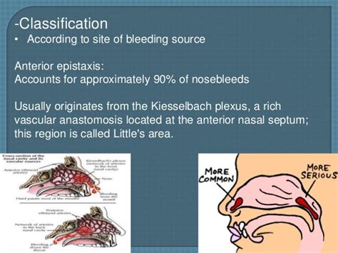 Epistaxis