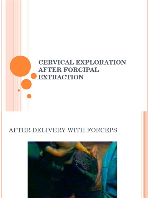 How To Explore After Forceps Extraction Pdf