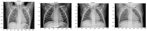 Using Convolutional Neural Networks In Tensorflow To Analyse Chest Xrays By Robby Sneiderman