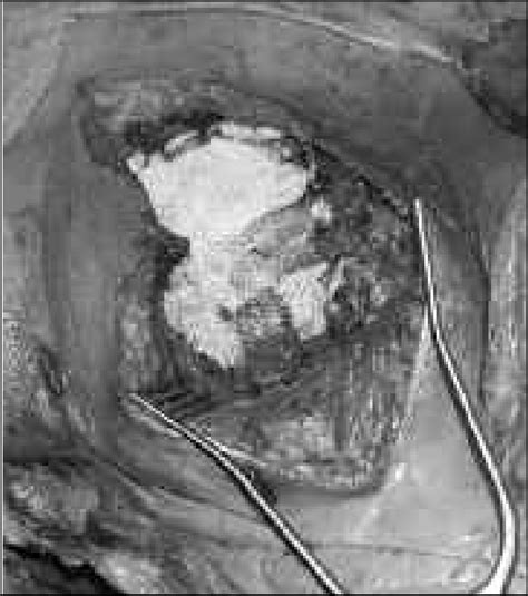 Intra Operative Photograph Of Osseous Defect And Reconstruction With Download Scientific