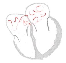Atrial fibrillation pathophysiology - wikidoc