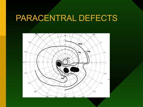 Fields In Glaucoma Normal And Abnormal John Oshea Pptx