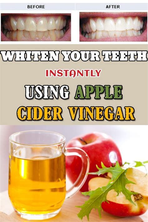 Apple Cider Vinegar Effect On Tooth Enamel At Amy Heyer Blog