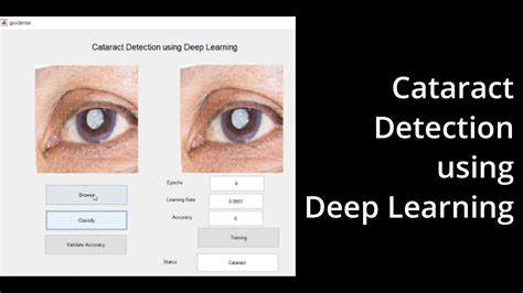 Cataract Detection Using Deep Learning Youtube