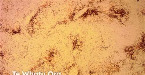 Immunohistochemistry Of Angioimmunoblastic T Cell Lymphoma Image