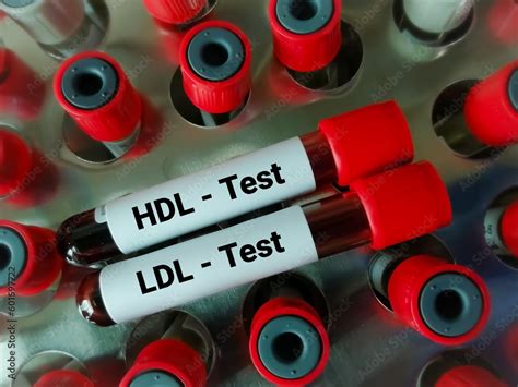 Blood Samples Isolated For HDL Cholesterol Good Cholesterol And LDL Cholesterol Bad