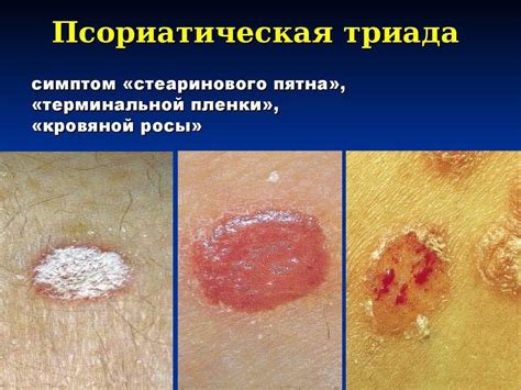 Псориаз – диагностика и лечение у опытного дерматолога в Москве.