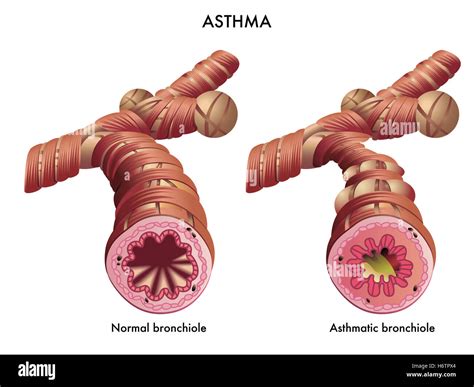 Asthma Disease Asthma Infection Respiration Illness Sickness Inhaler