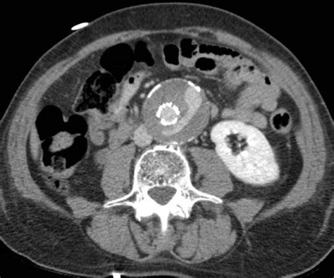 Endoleak Cta Radrounds Radiology Network