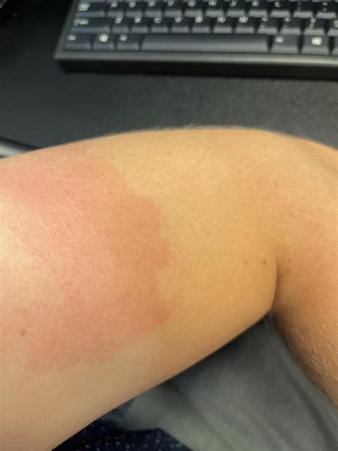 Help Rash Near Injection Site Rtestosterone