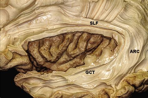 Anatomy Of The Optic Radiations From The White Matter Fiber Dissection