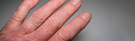 Psoriatic Arthritis Sintomas Sanhi Medikoph