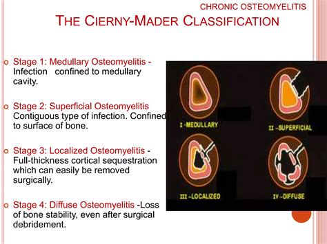 Osteomyelitis Pptx