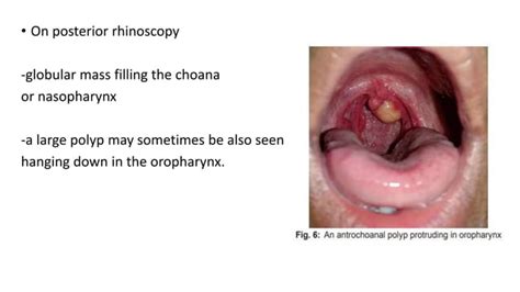 Nasal Polyp Antrochoanal Polyp Ethmoid Polyp Pptx