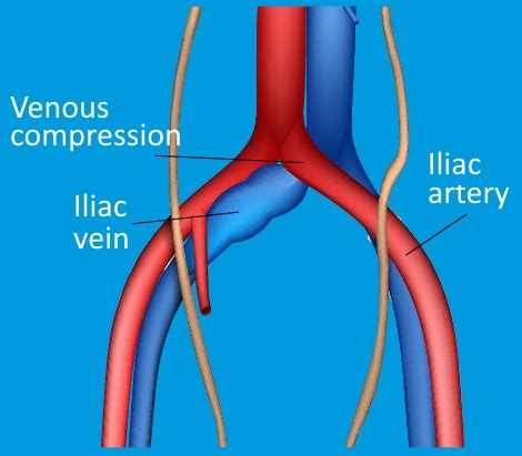 Common Iliac Vein