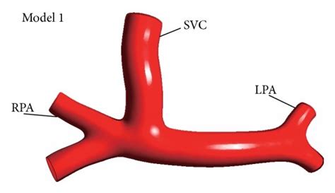 A Series Of 3d Modified Models With Different Stenosis Rate At The Left