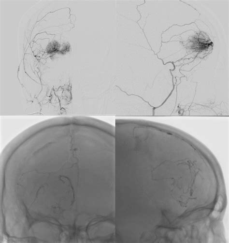 Hemangiopericytoma Pial And Dural Embo