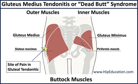 Gluteus Medius Tendonitis Gluteal Tendinopathy Or Dead Butt Syndrome
