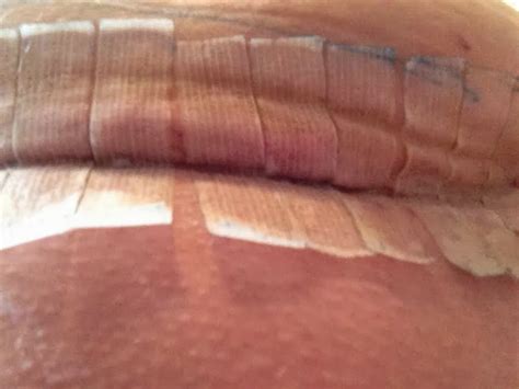 Cellulitis Infection From C Section ~ Cellulite And Exercise