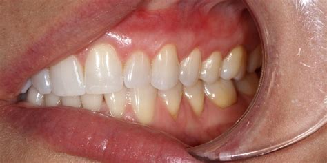 Care 4 Teeth Senior Dentistry Dentures Gum Recession