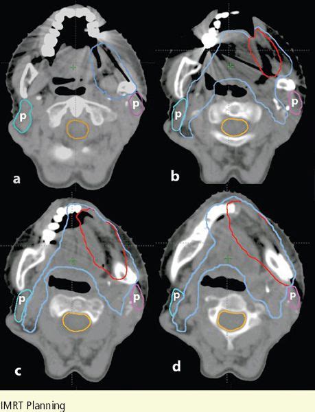Buccinator Muscle Mri