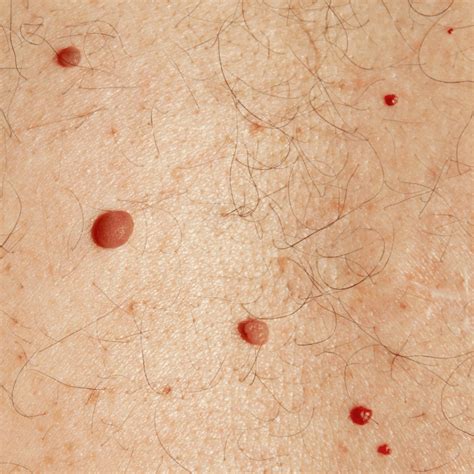 What Causes Cherry Angiomas What Is A Cherry Angioma Causes