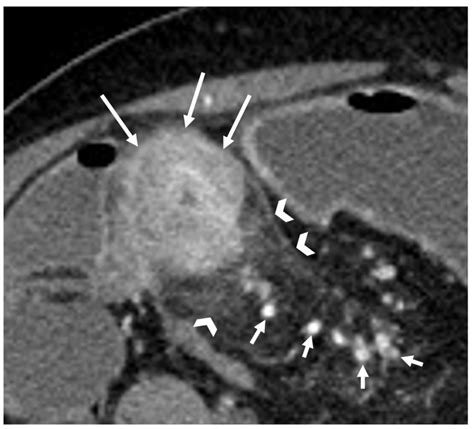 Imaging Of Strictures In Crohns Disease