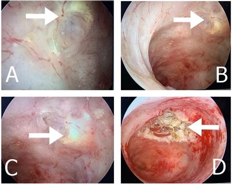 Uterine Tumors Resembling Ovarian Sex Cord Tumors Utroscts A Scoping
