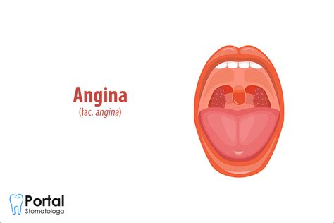 Angina Portal Stomatologa