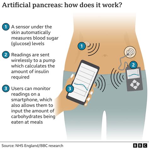 what is the new artificial pancreas for diabetes health service