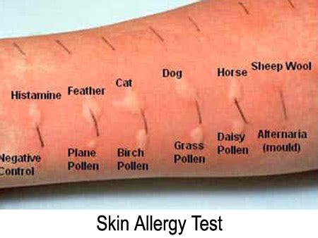 Allergy MDNotes