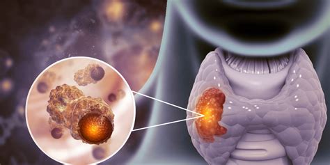Cáncer De Tiroides Netmd Hub De Salud Independiente Producción Y