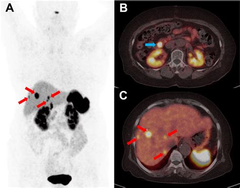 Representative Case Of A 77 Year Old Male With A Primary Duodenal Net