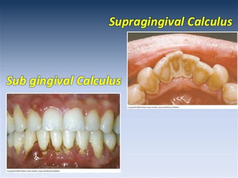Etiology Of Periodontal Disease