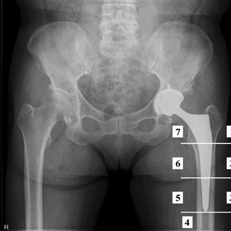 Postoperative X Ray And Periprosthetic Bone Mineral Density Download Scientific Diagram