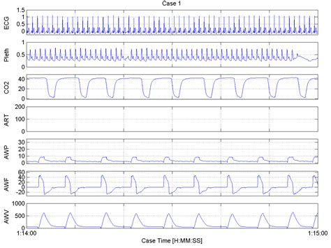 Case 1 Waveform Plots 60 Second Plots