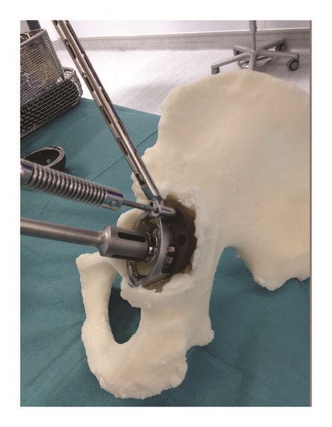 Preoperative Templating Implant Sizing And Surgical Stimulation Download Scientific Diagram