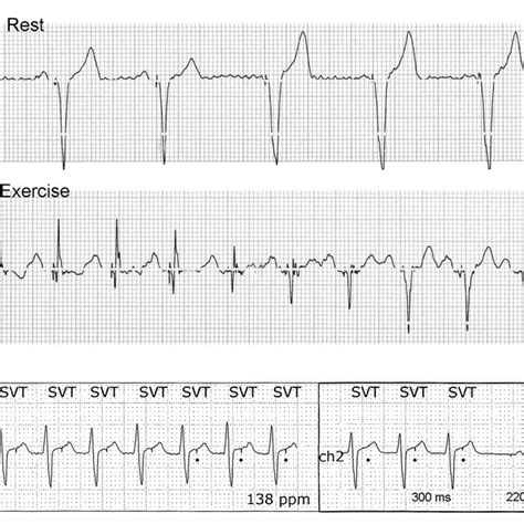 Patient With Complete Av Block And A Ddd Pacemaker Sensed Av Download Scientific Diagram