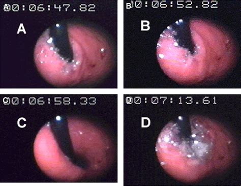 Lower Esophageal Sphincter Endoscopy