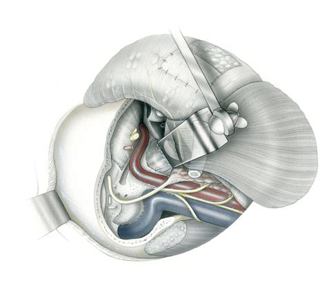 Infratemporal Fossa Approaches Skull Base Surgery Atlas
